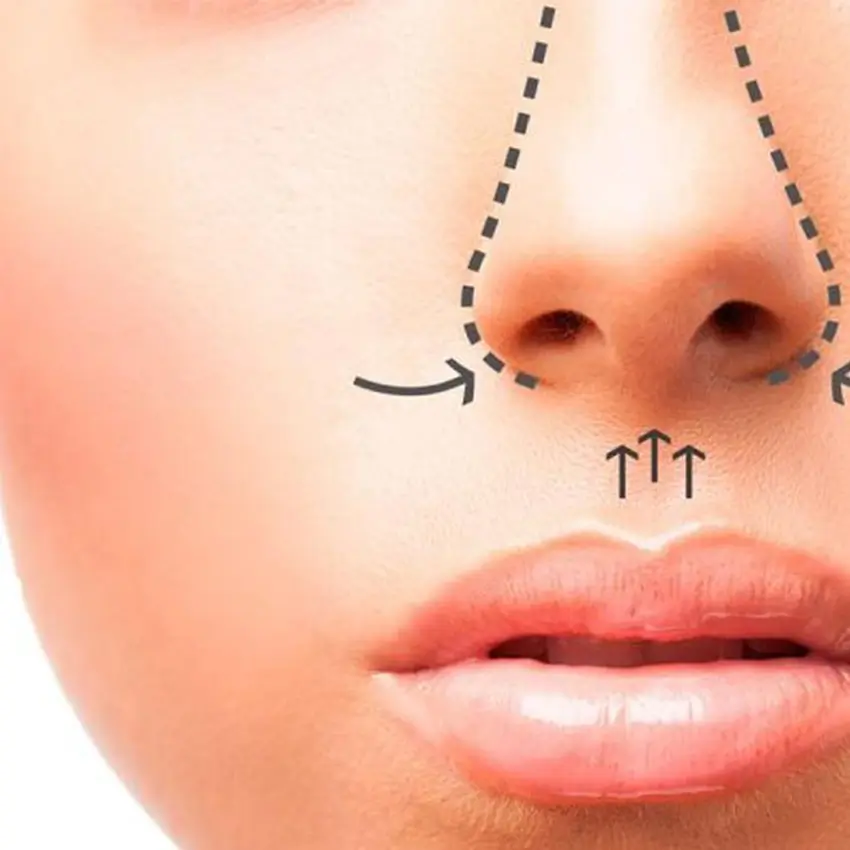 Estruturação Dinâmica na Rinoplastia – Spreader Flaps - Dr Ronche